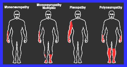What is Peripheral Neuropathy?